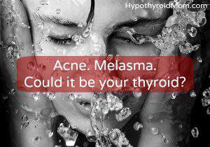 Acne. Melasma. Could it be your thyroid? | Hypothyroid Mom